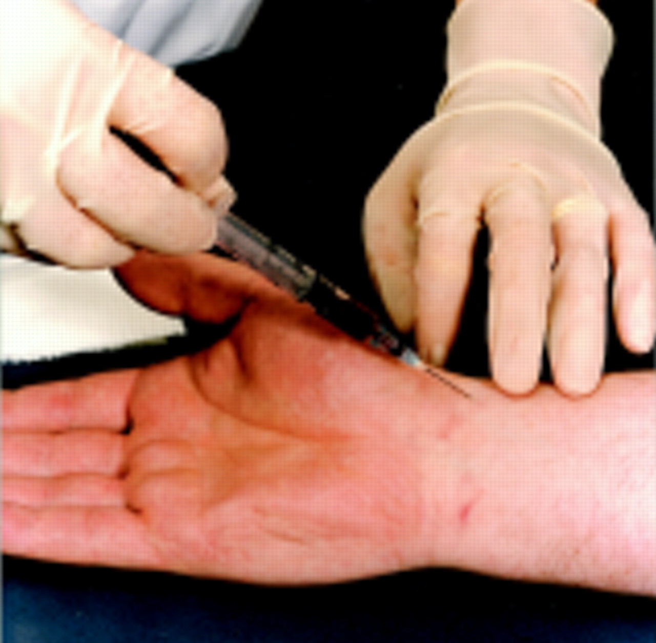 How To Get Arterial Blood Gas