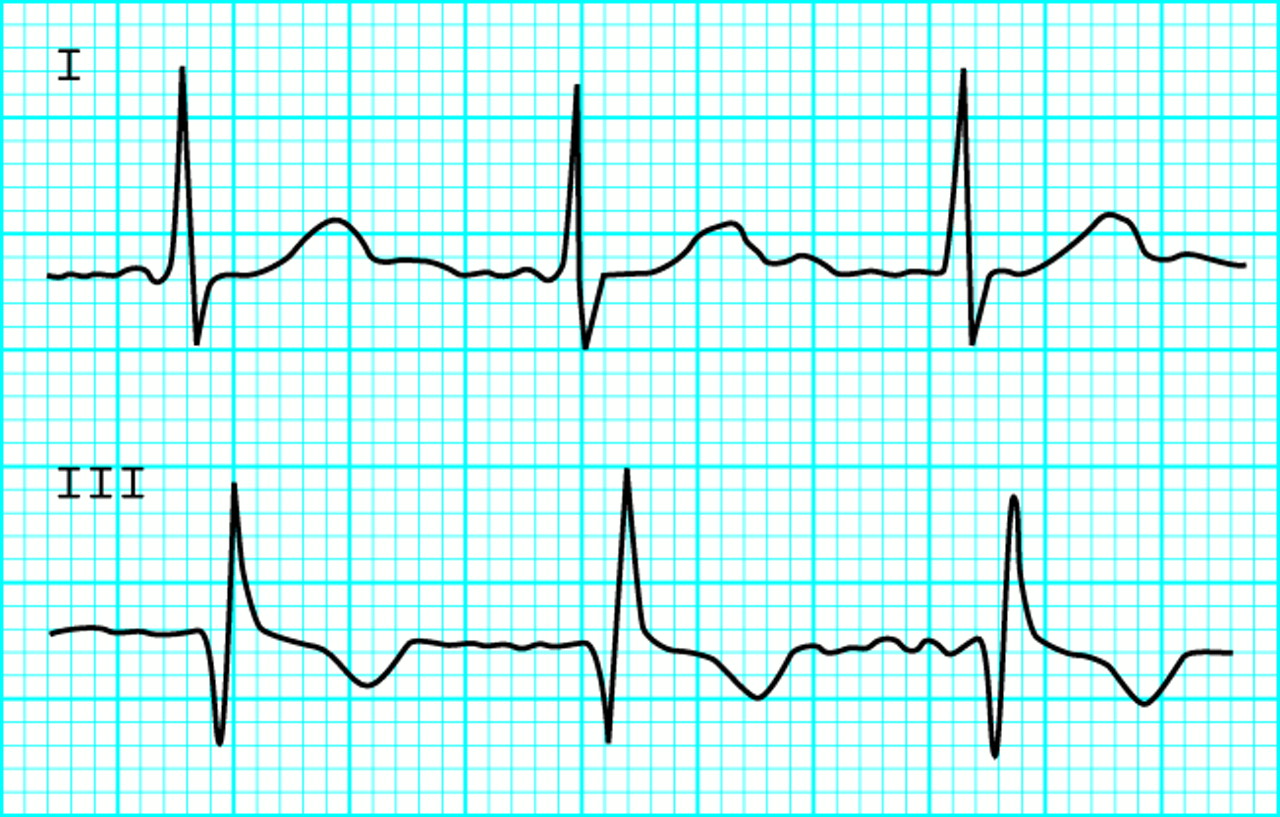 Conditions affecting the right side of the heart | The BMJ