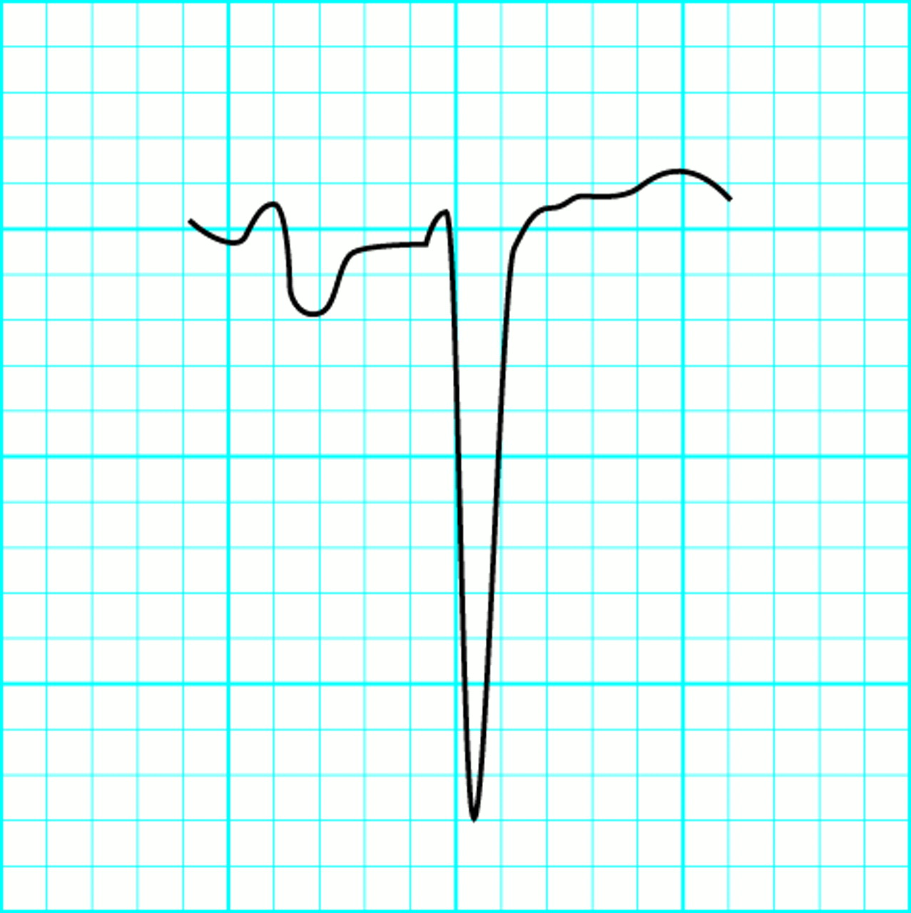 Conditions affecting the left side of the heart | The BMJ