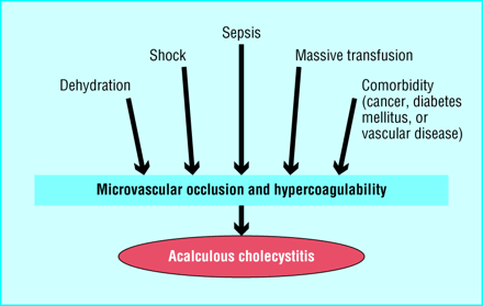 Acute cholecystitis | The BMJ