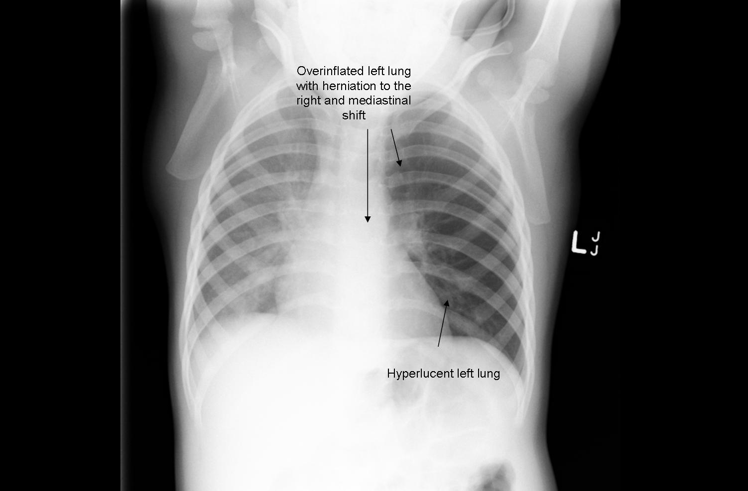 A 20 month old girl with respiratory distress | The BMJ