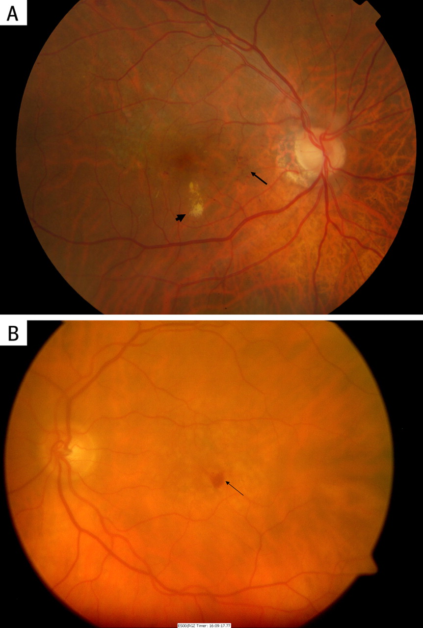 Managing diabetic retinopathy | The BMJ