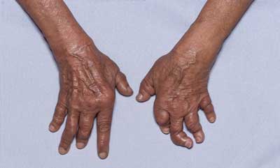 Psoriatic arthritis | The BMJ