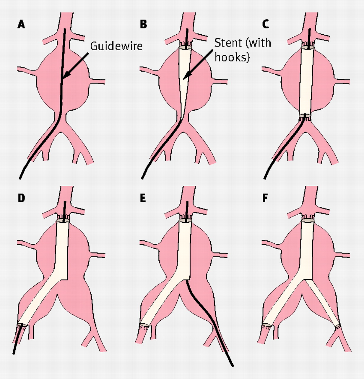 The management of abdominal aortic aneurysms | The BMJ