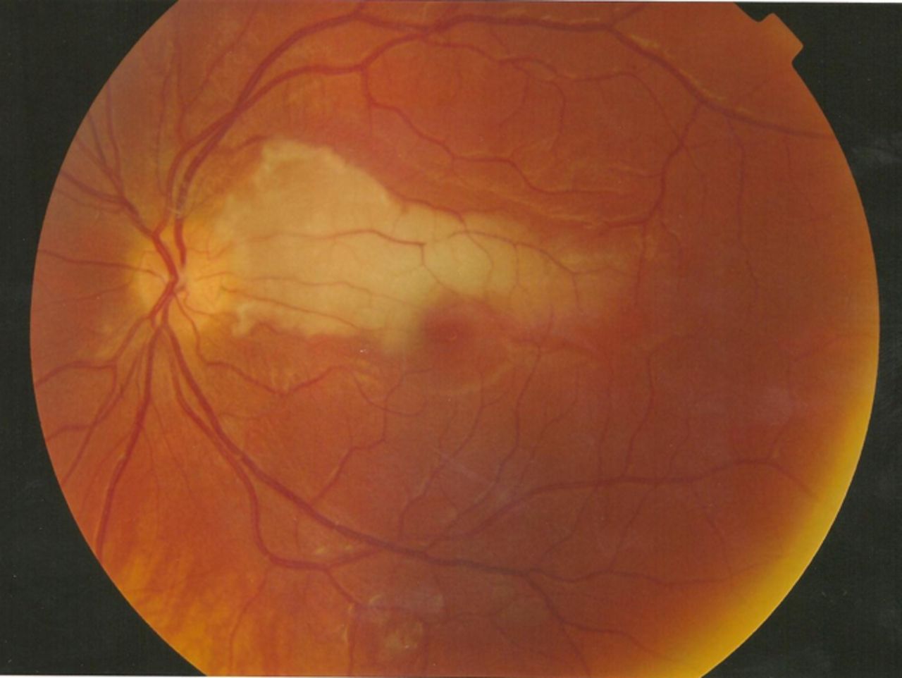 Loss of vision from a patent foramen ovale | The BMJ
