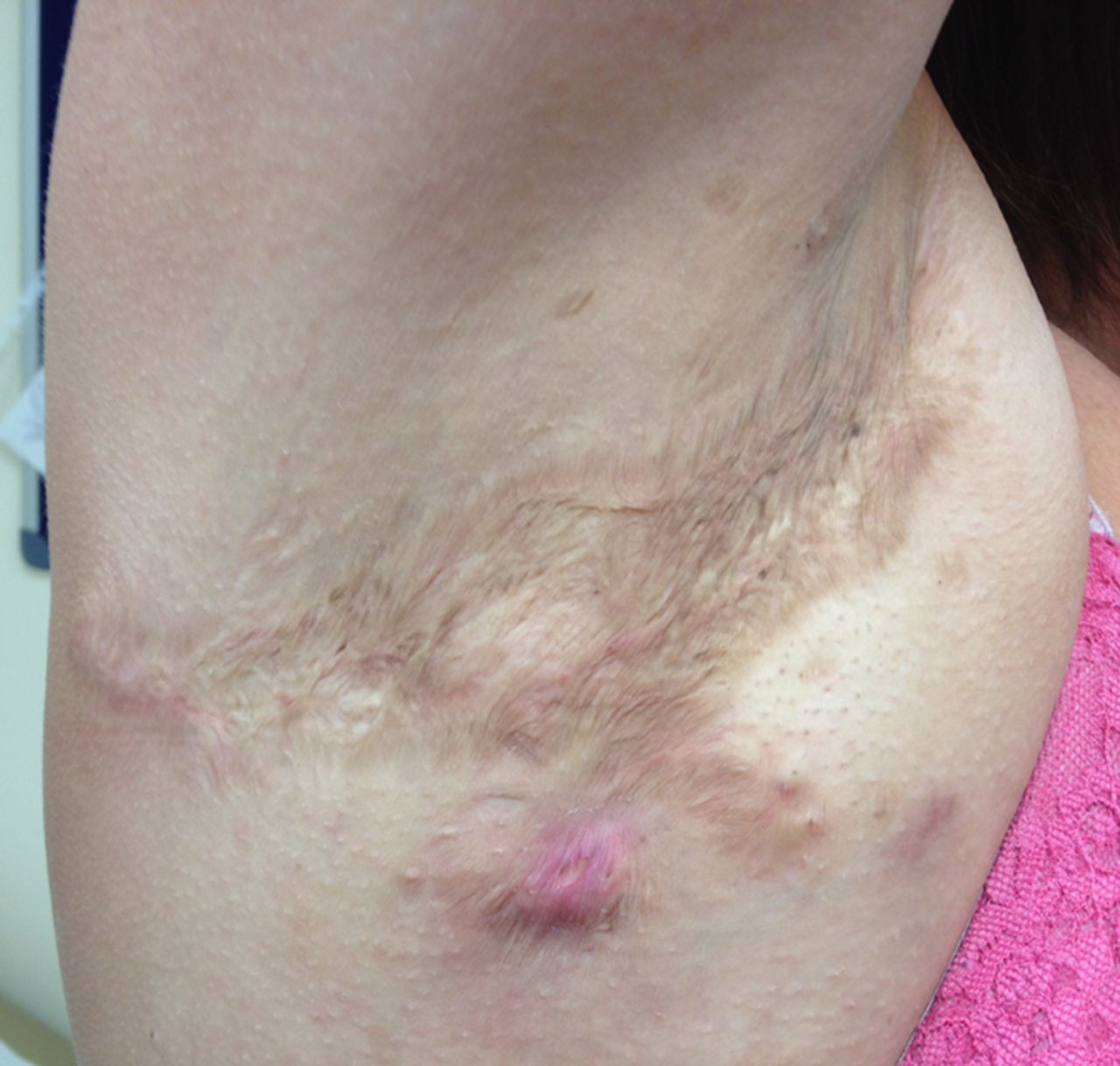 Diagnosis and management of hidradenitis suppurativa | The BMJ