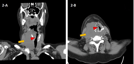 Airway obstruction after the development of Hashimoto’s thyroiditis ...