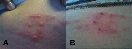 Skin disease in pregnancy | The BMJ