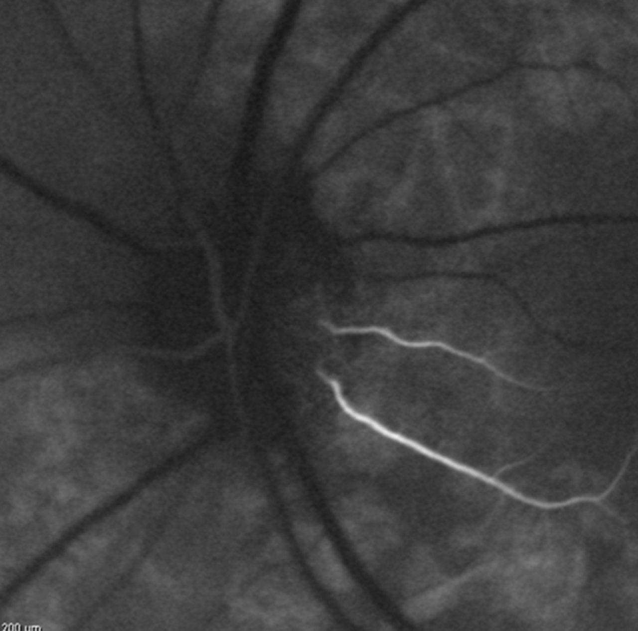 Sudden unilateral painless loss of vision | The BMJ