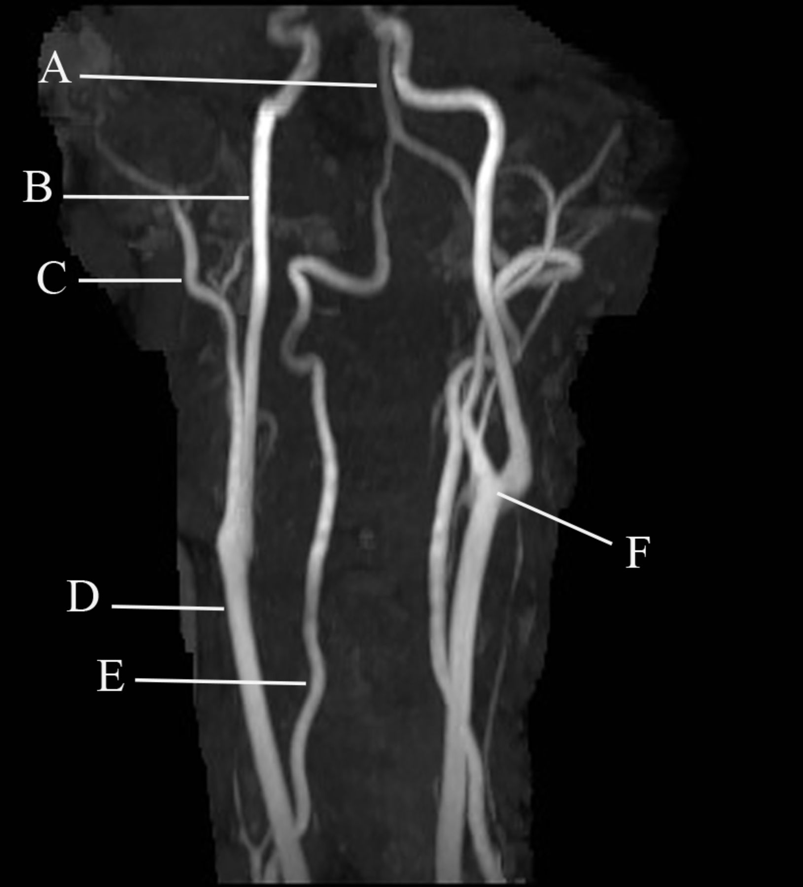 Magnetic resonance arteriography of the neck: time of flight sequence ...