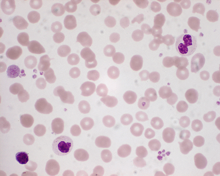 Neutropenia in primary care | The BMJ
