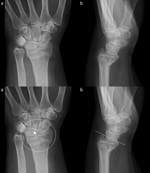 Interpreting the wrist radiograph in adult trauma | The BMJ