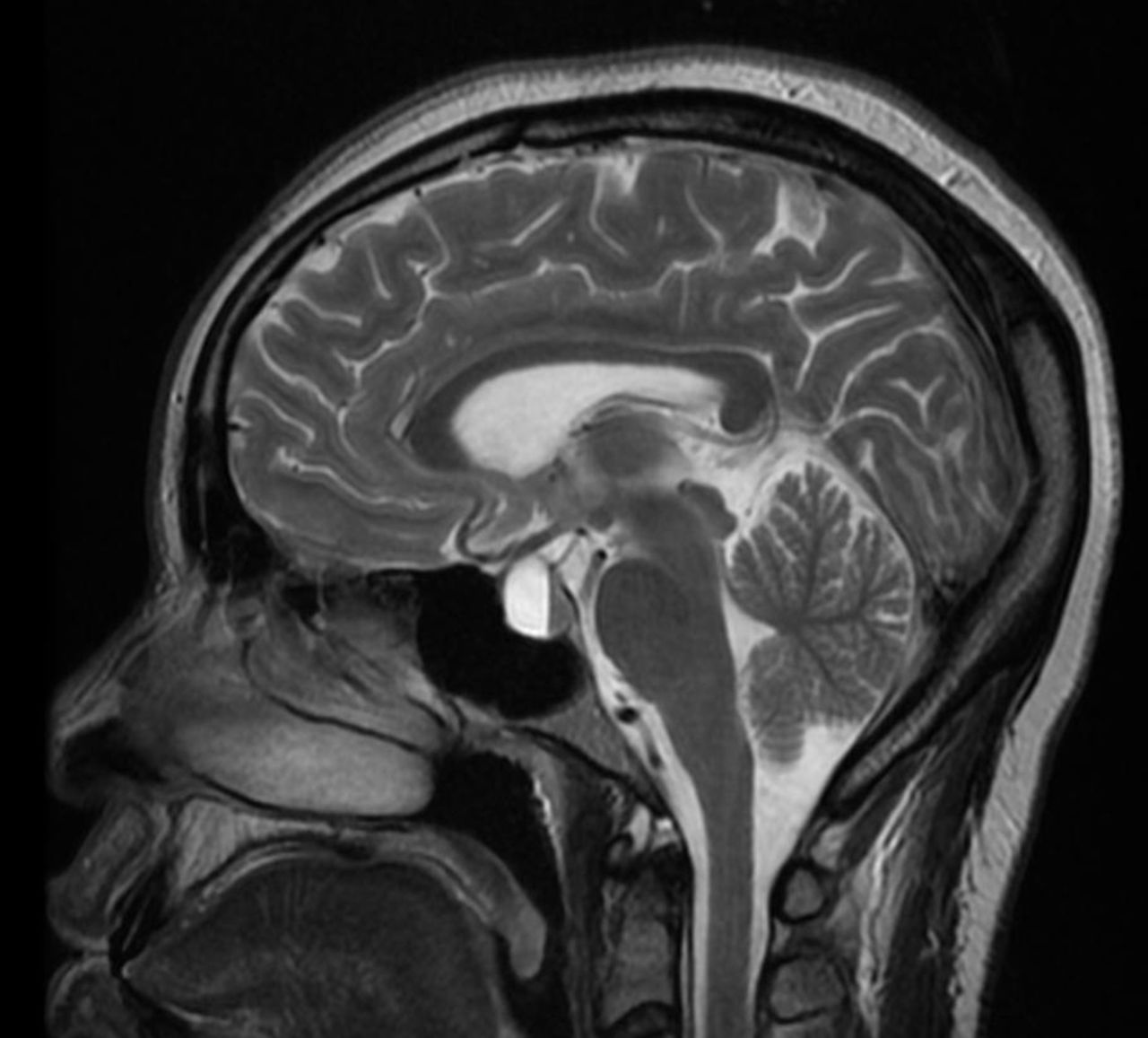 An unusual cause of headache in pregnancy | The BMJ