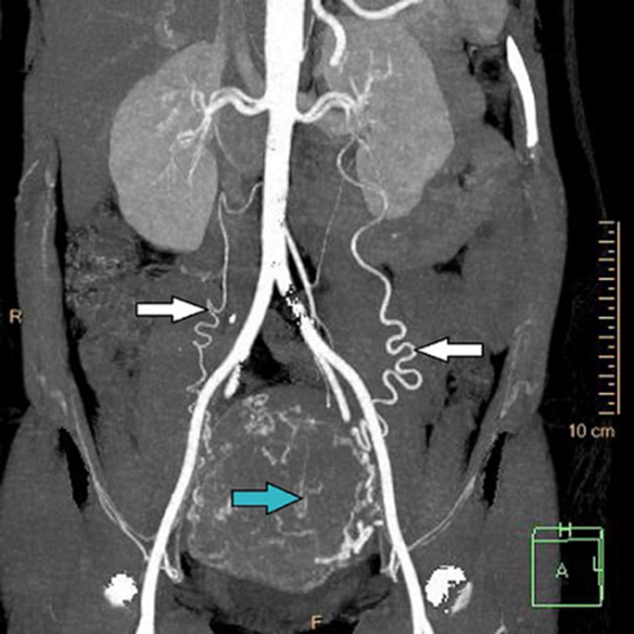 Ovarian Artery