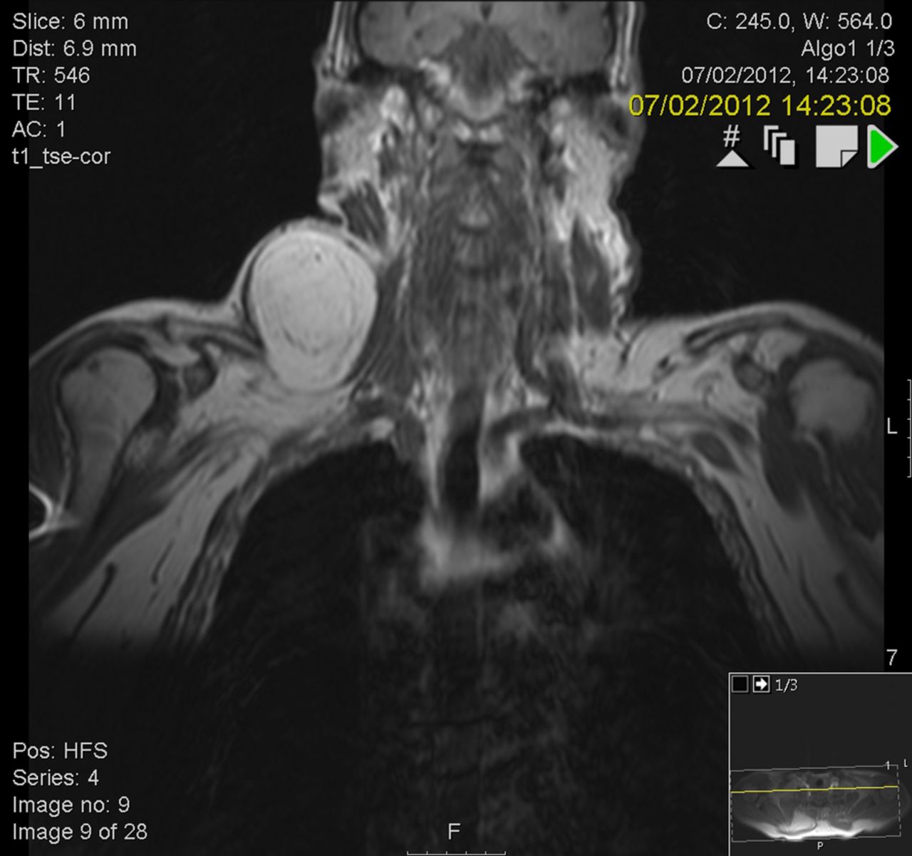 A supraclavicular swelling | The BMJ