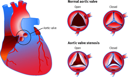 Aortic stenosis: diagnosis and management | The BMJ