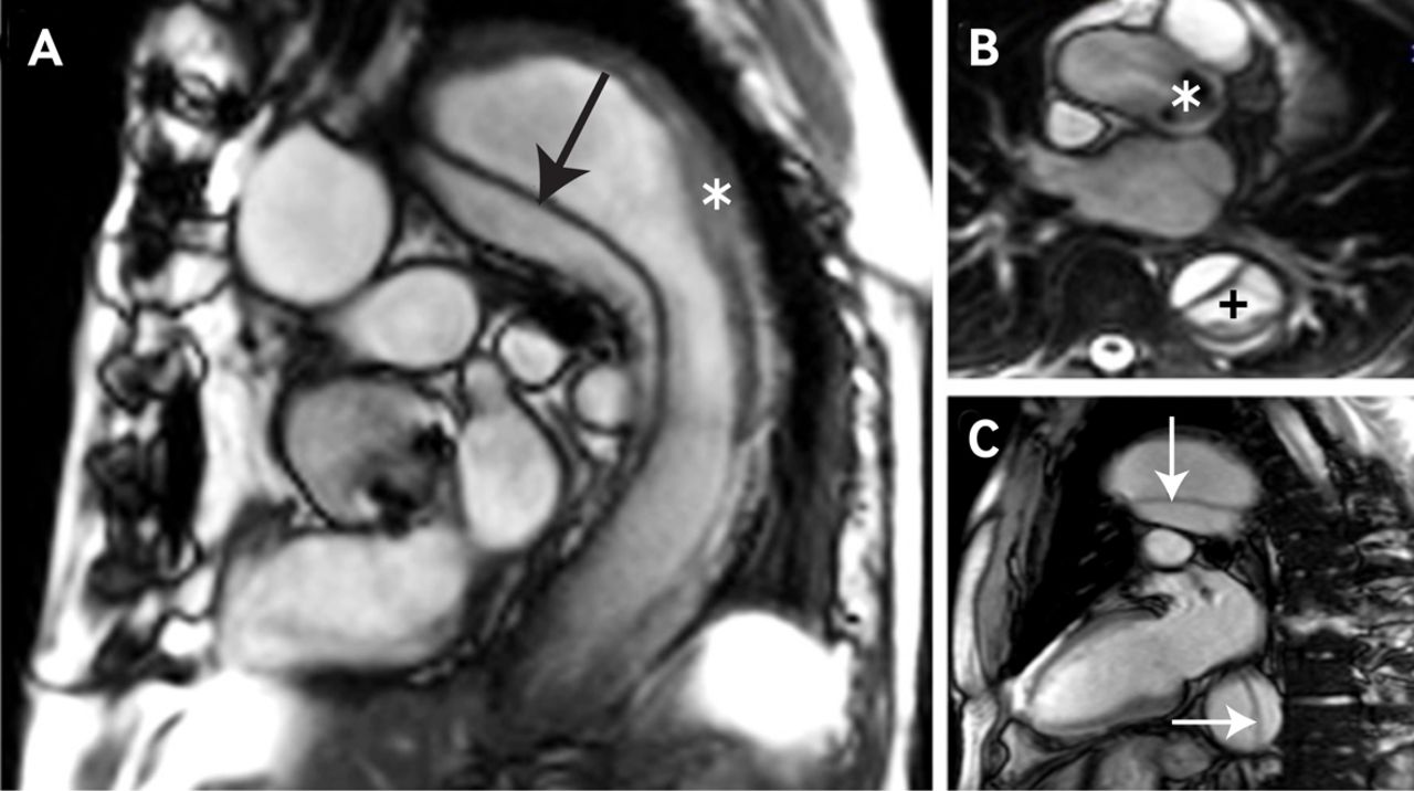 Well patient, worrying thoracic magnetic resonance aortogram | The BMJ
