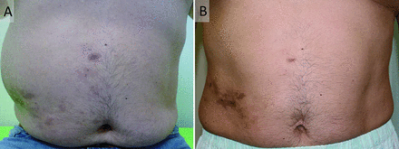 Postherpetic abdominal pseudohernia | The BMJ