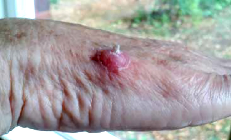 Just a cutaneous (keratotic) horn? | The BMJ