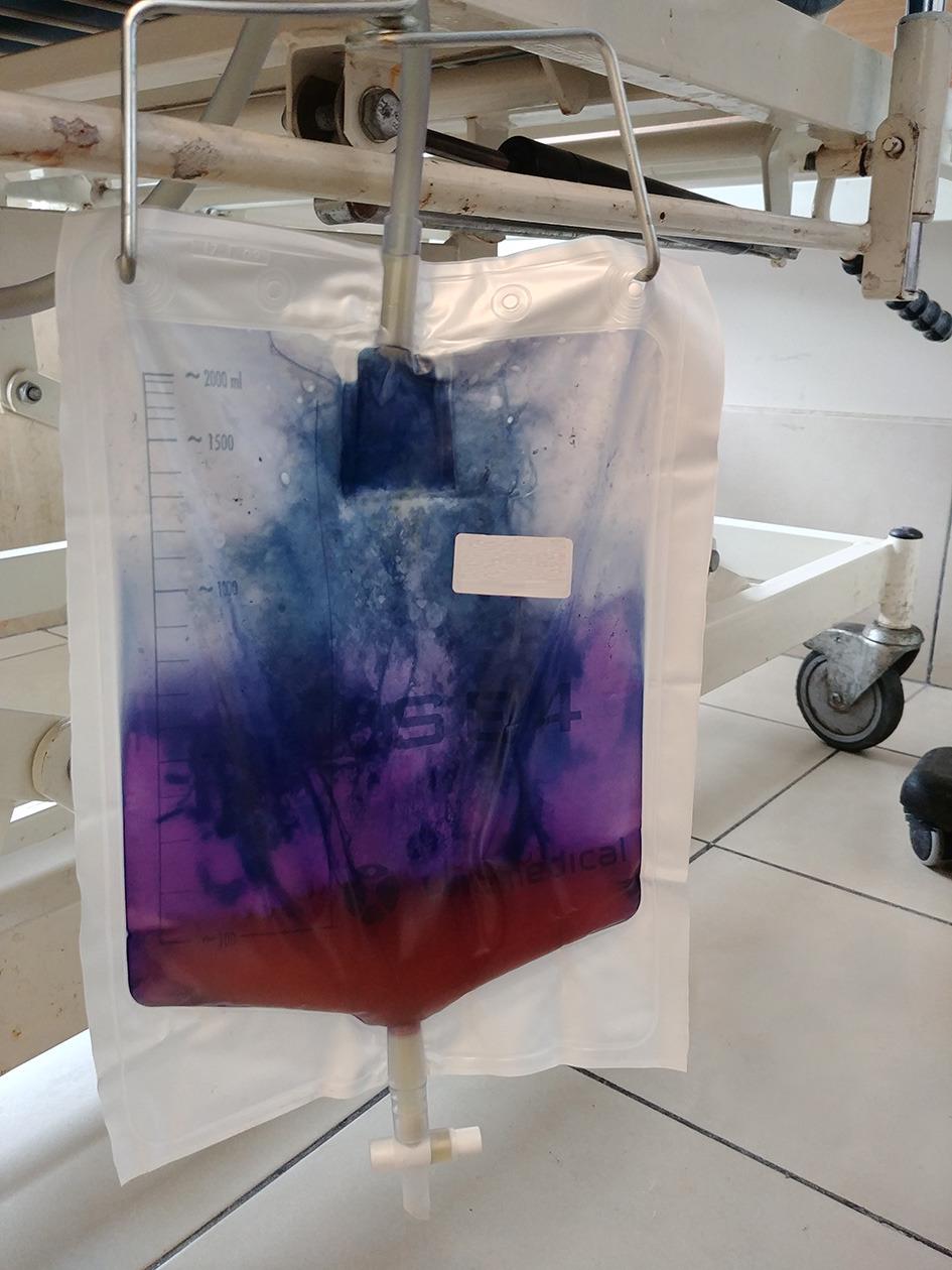 Purple urine bag syndrome | The BMJ