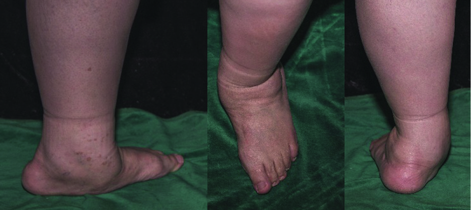 Adult flatfoot | The BMJ
