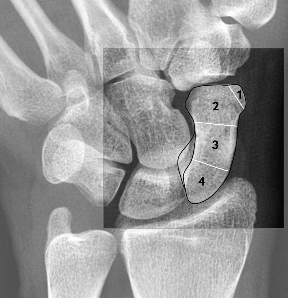 Fractures Of The Scaphoid The BMJ