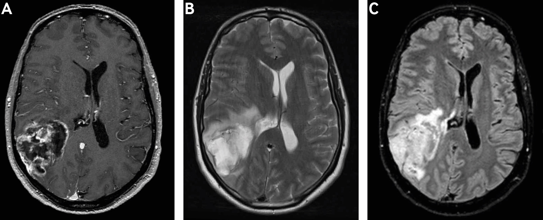 Glioblastoma: clinical presentation, diagnosis, and management | The BMJ