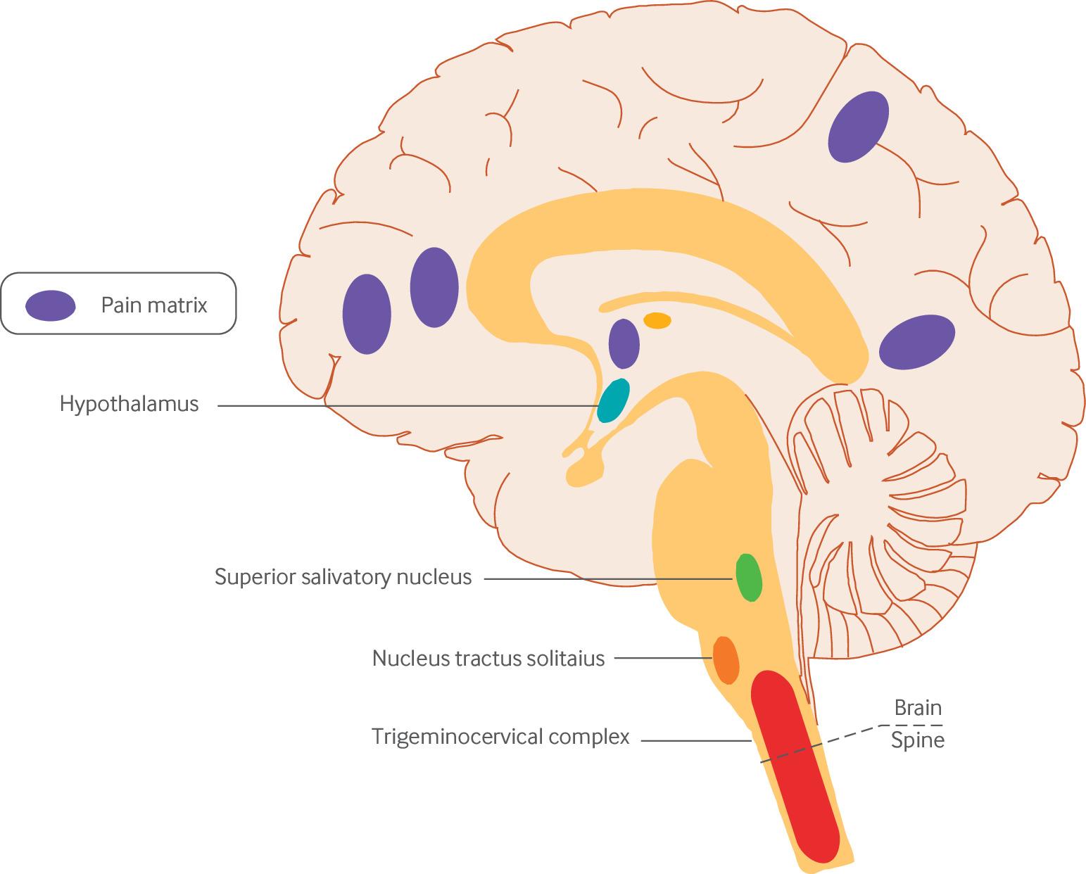 Prevent Cluster Headaches