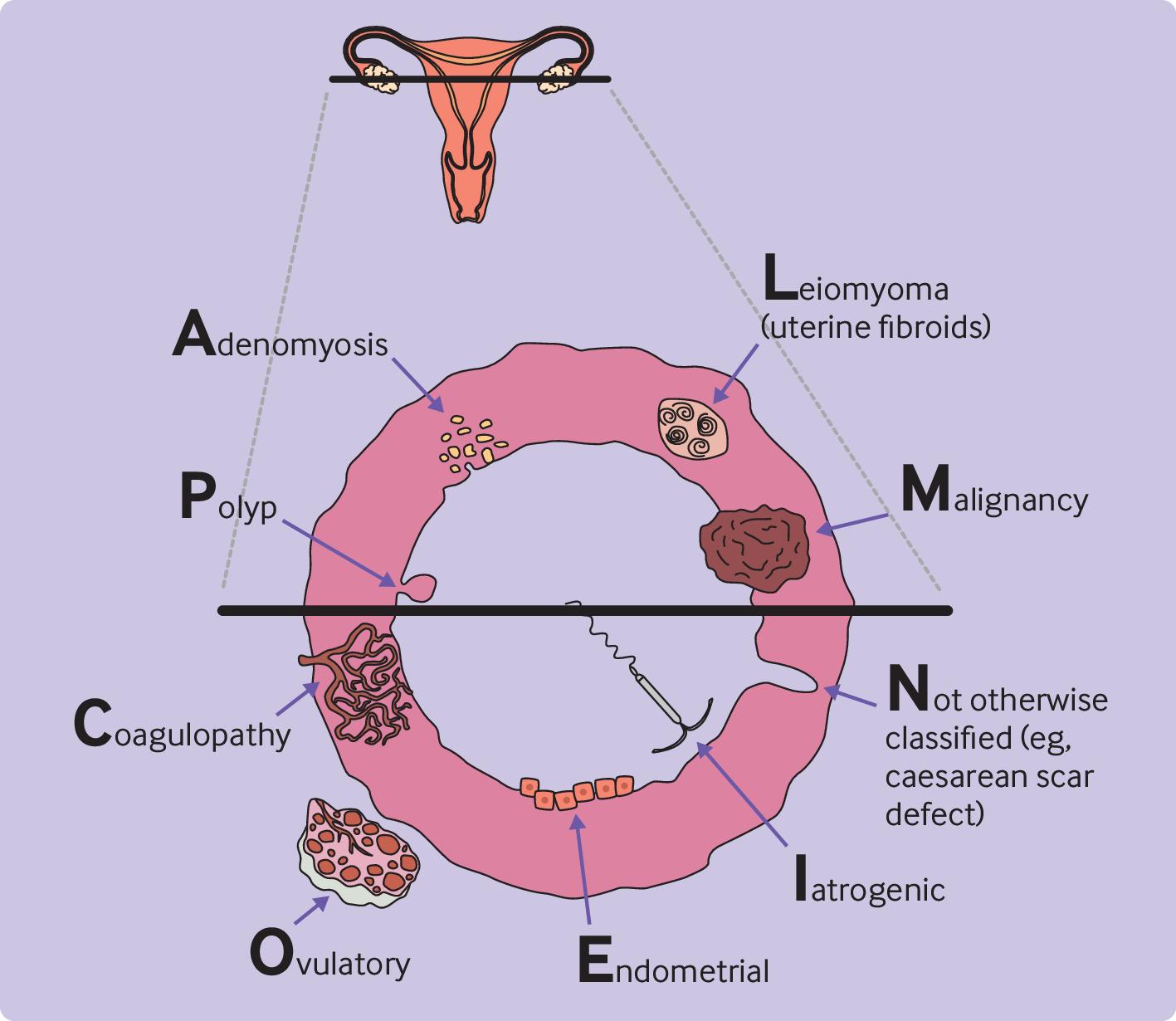 Abnormal Uterine Bleeding Treatment Options For Abnormal Menstruation