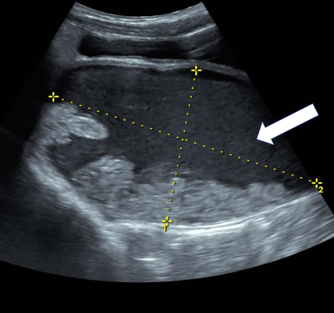 An adolescent girl with acute abdominal pain and abdominal mass | The BMJ