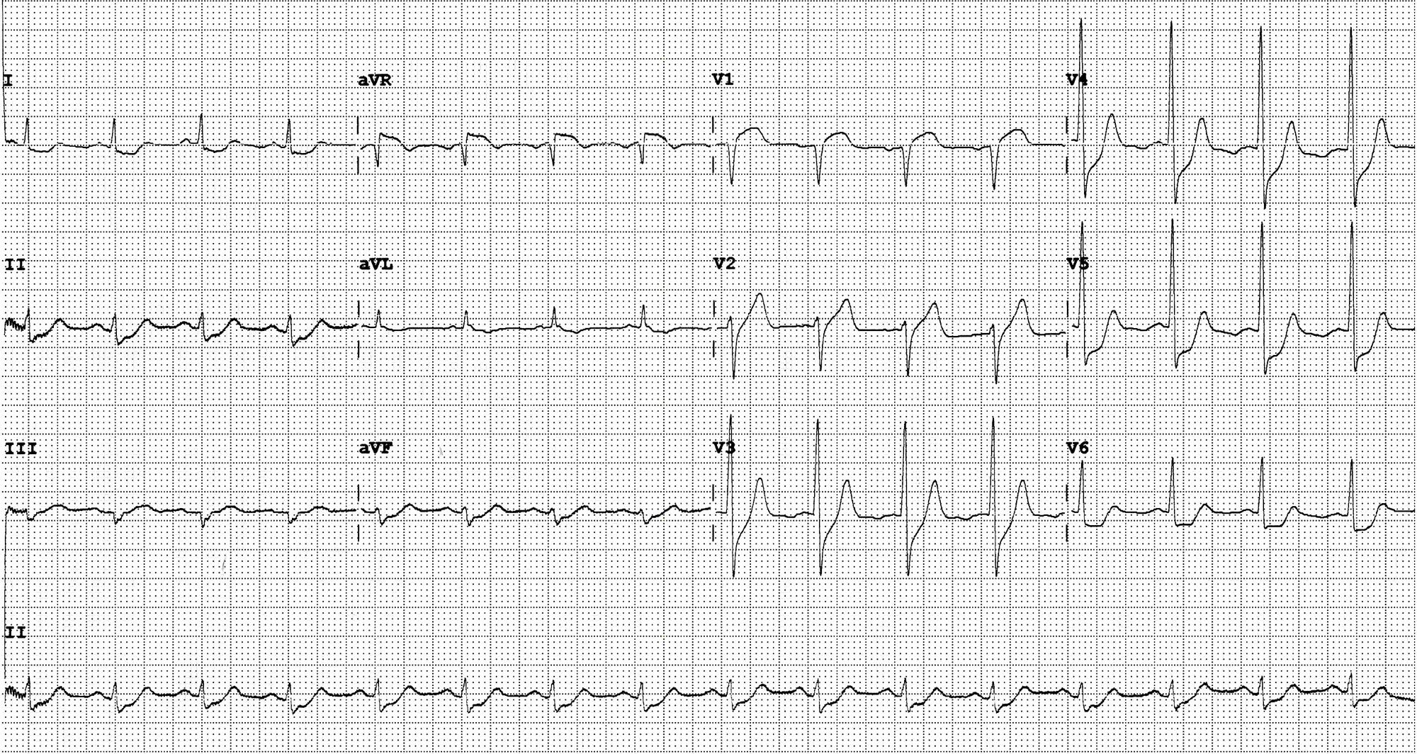 A man with ST segment depression | The BMJ