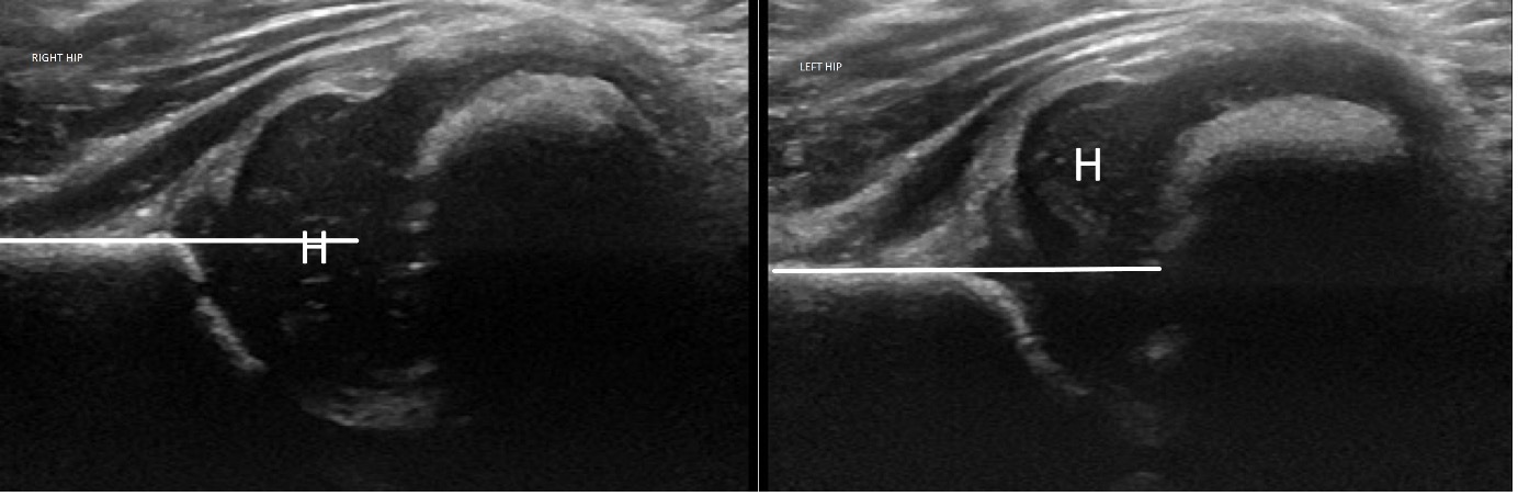 Developmental dysplasia of the hip in infants and children | The BMJ