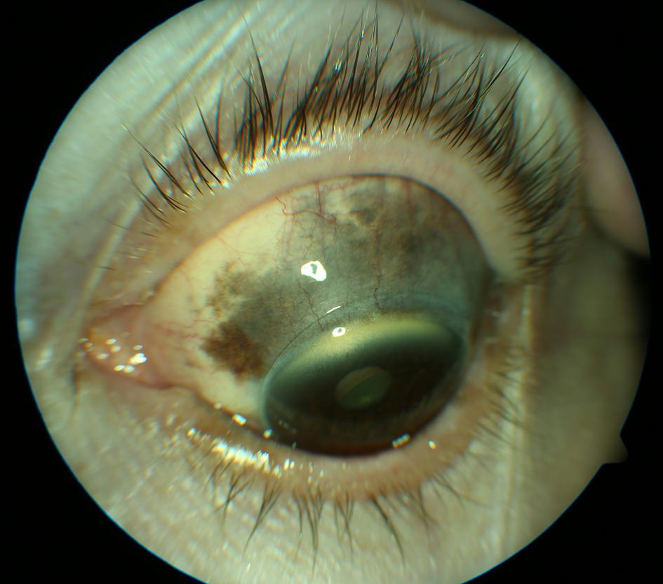 Ocular Melanoma Keep An Eye On Common Risk Factors For Ocular Melanoma
