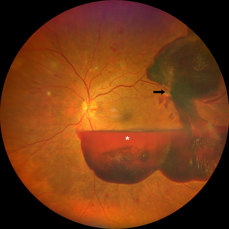 A boat shaped bleed | The BMJ