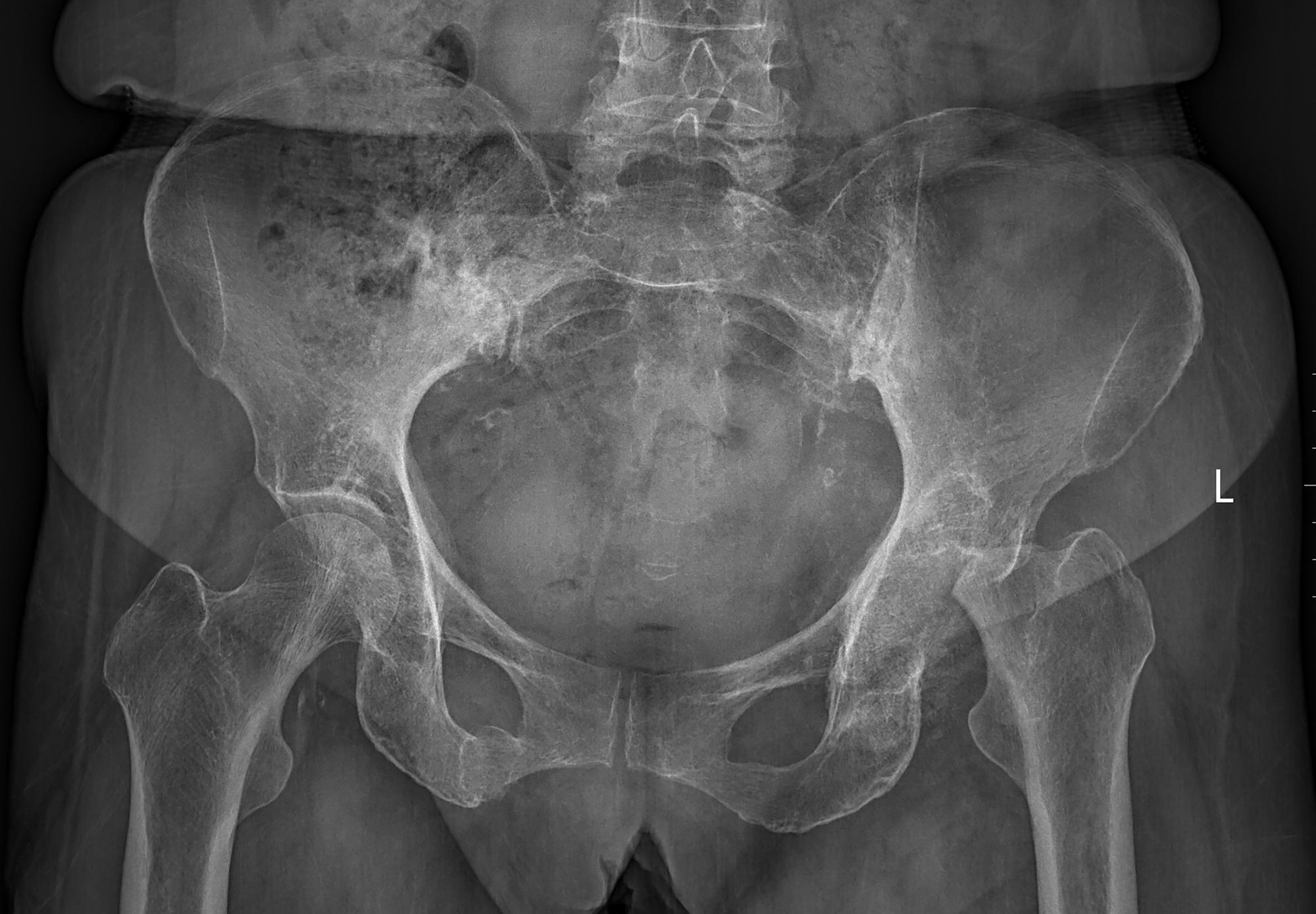 Isolated femoral head destruction | The BMJ