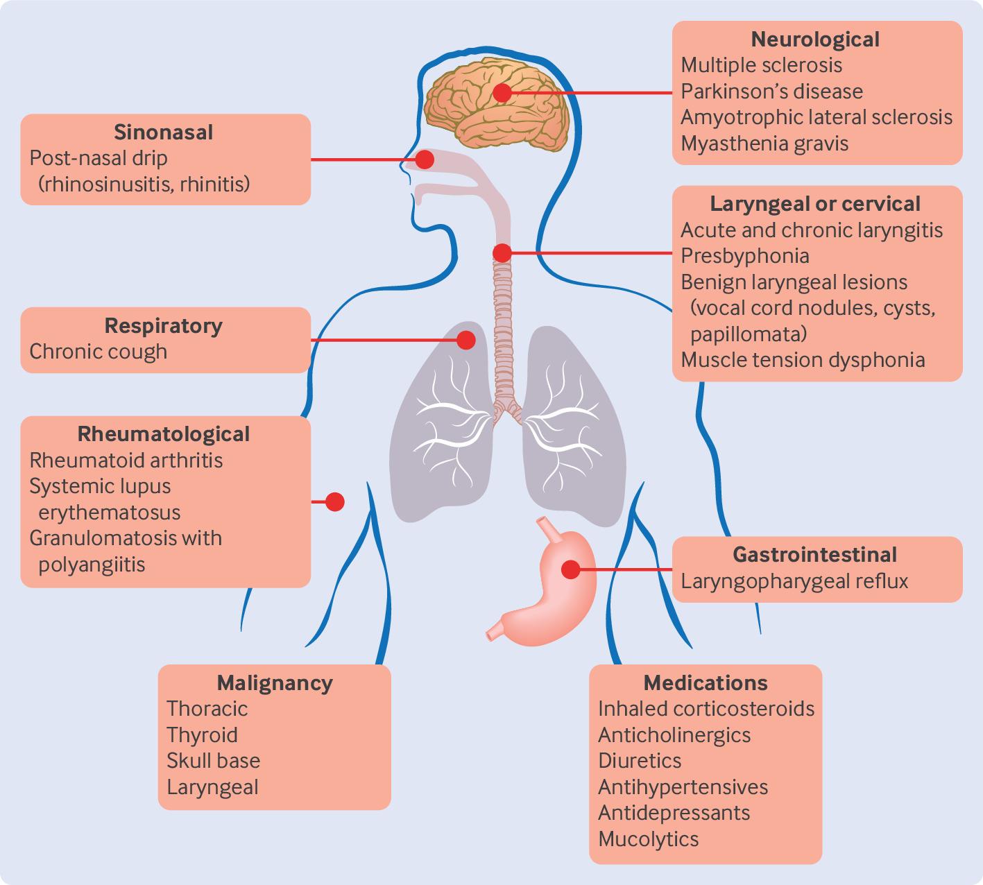 Chronic Laryngitis Nhs