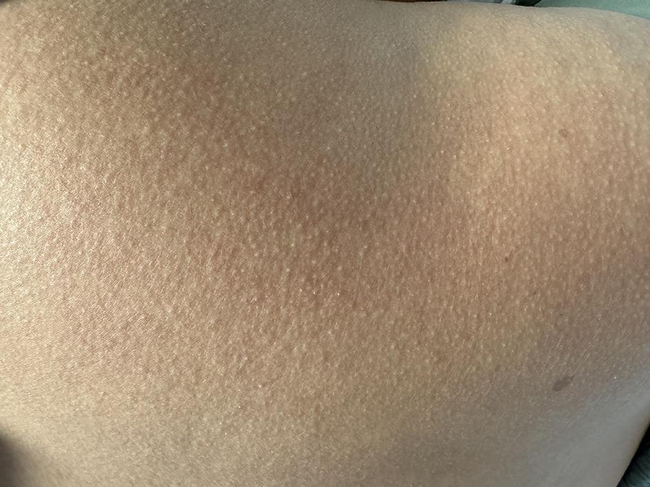 Sandpaper Textured Rash