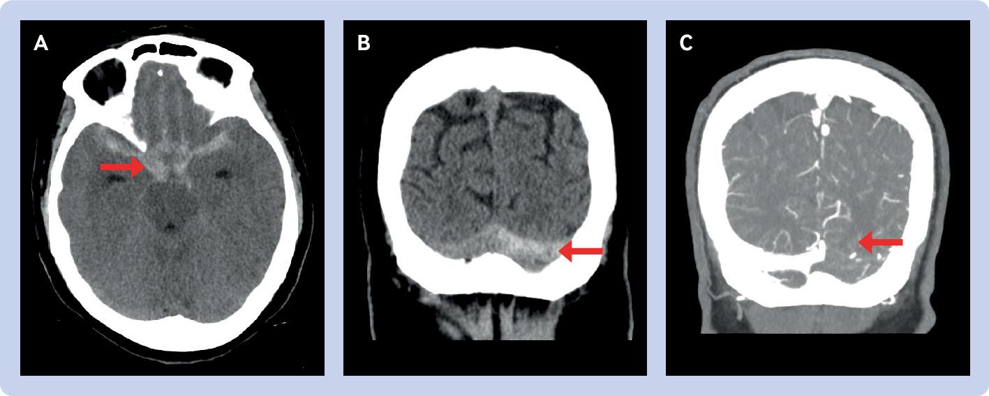 Assessment and investigation of thunderclap headache | The BMJ