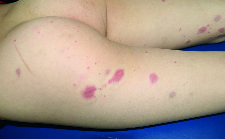 A boy with swollen and painful hands | The BMJ