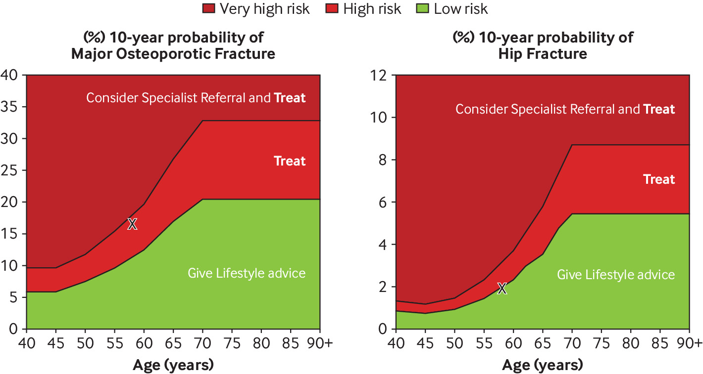 10-Minute Consultation: Osteopenia | The BMJ